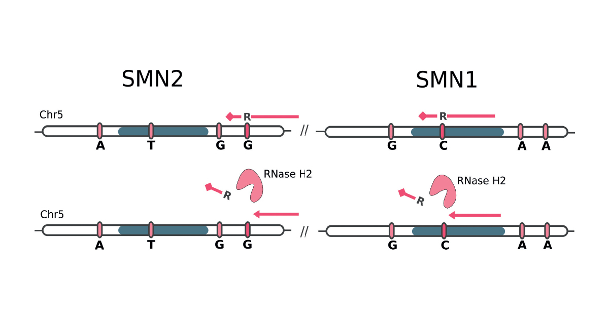 SMN1/SMN2 and spinal muscular atrophy case report - Blueprint Genetics